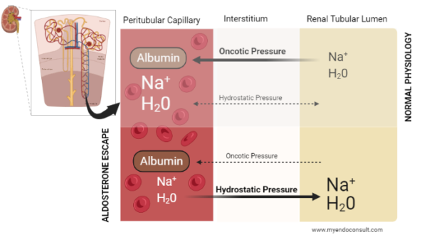 Aldosterone Renin Ratio - My Endo Consult