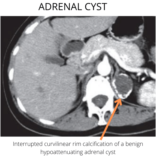 Adrenal Gland Calcification My Endo Consult Adrenal Gland Calcification My Endo Consult